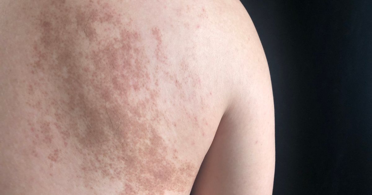 Lézeres szőrtelenítés Becker nevus esetén: mit kell tudnod?